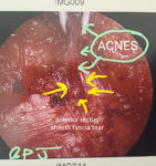 Anterior Cutaneous Nerve Entrapment Syndrome NYC