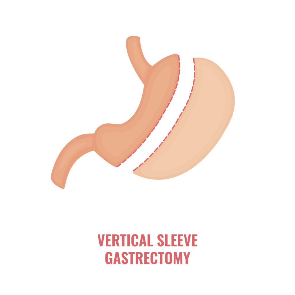 Sleeve Gastrectomy NYC - Premier Gastric Sleeve Surgeon NYC